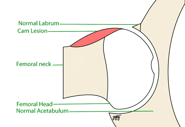 Femoroacetabular Impingement (FAI) | Symptoms, Causes & Treatment ...